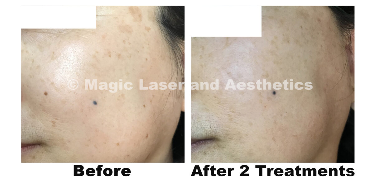 The best laser dark spots | Melasma treatment in Toronto - Magic Laser ...